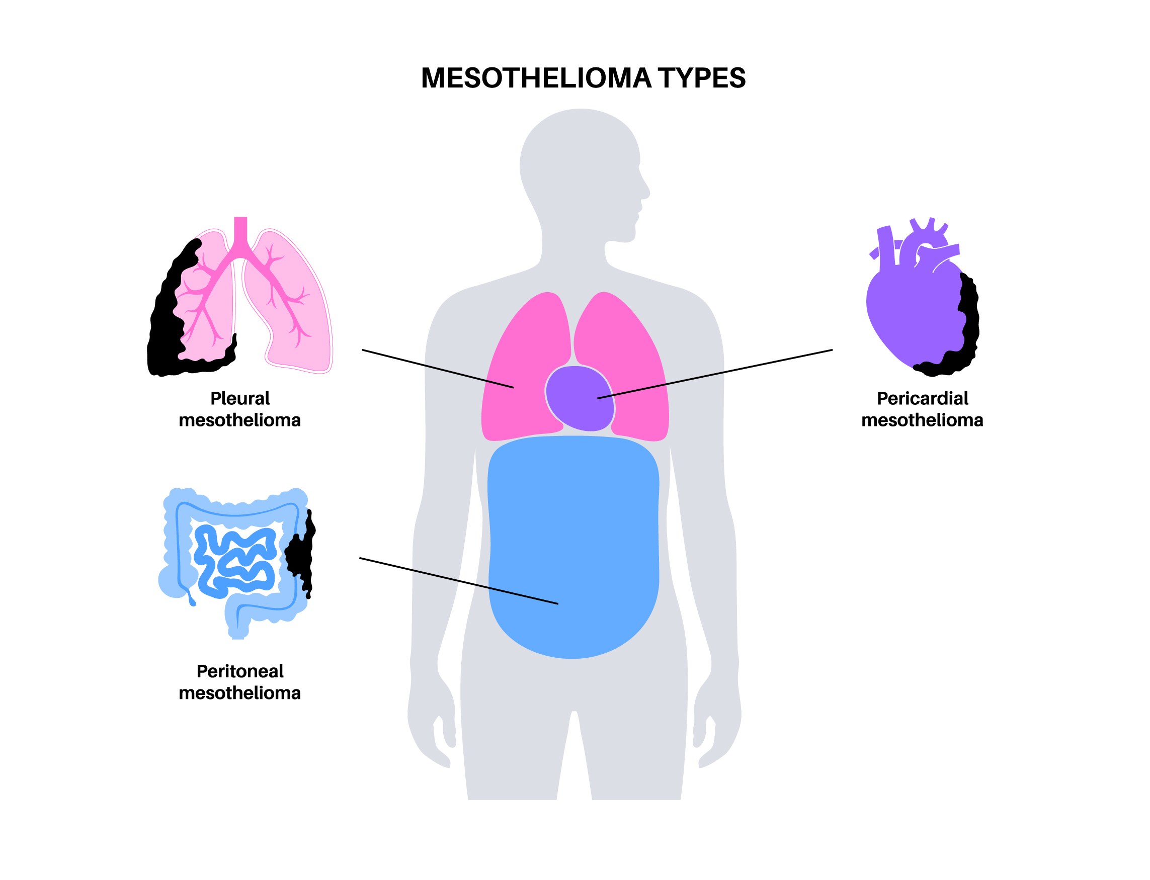 Types of Mesothelioma